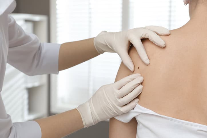 How to Check for Melanoma | Kettering Health